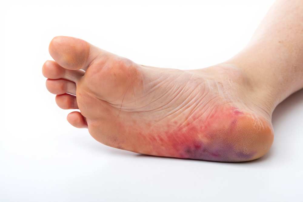 Pied diabétique : Symptômes, causes et traitement
